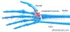 주상골 골절scaphoid Fracture 넘어진 뒤에 엄지 손가락 쪽 손목이 아파요 네이버 블로그